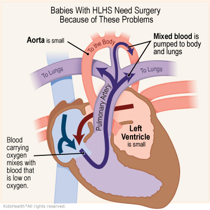 Hypoplastic Left Heart Syndrome Surgery: The Norwood Procedure (for ...